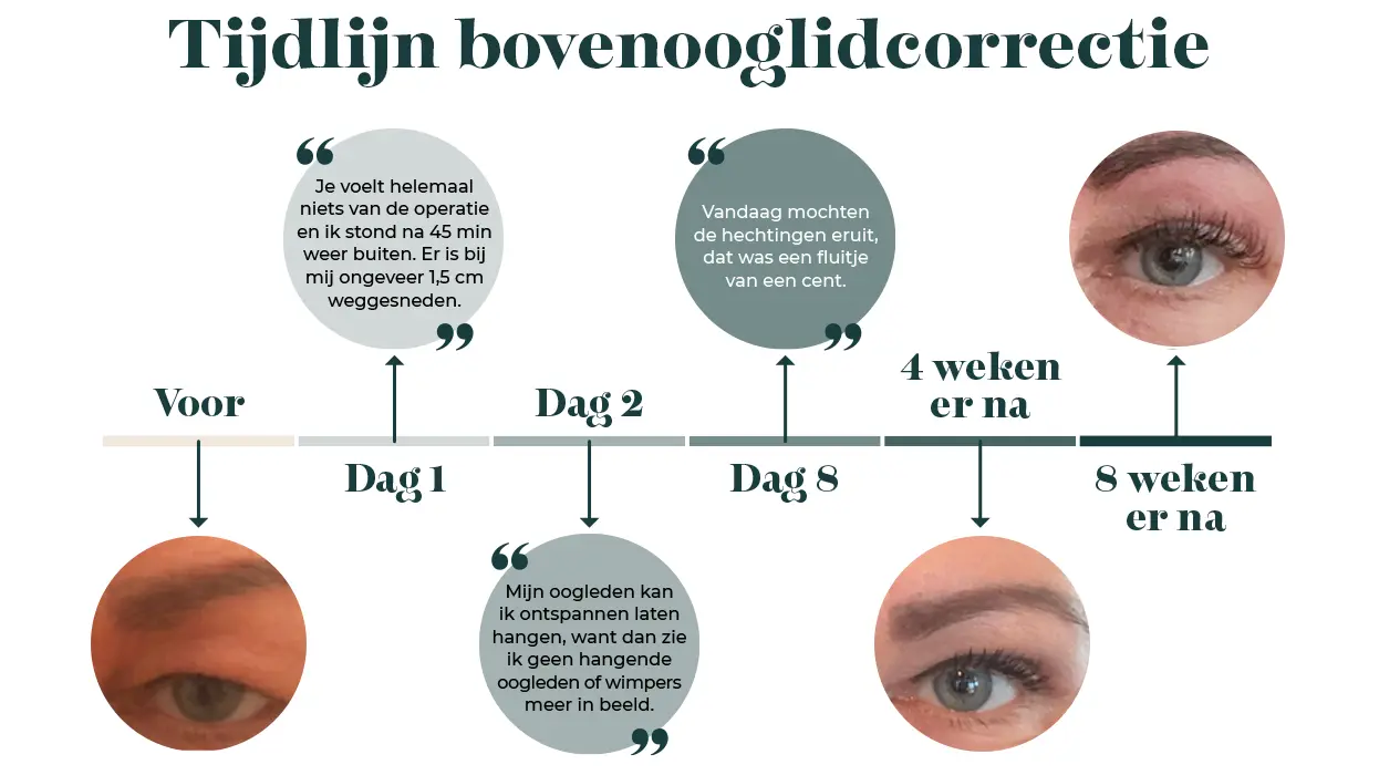 Ooglidcorrectie Bovenoogleden Van Nanc Blog Faceland